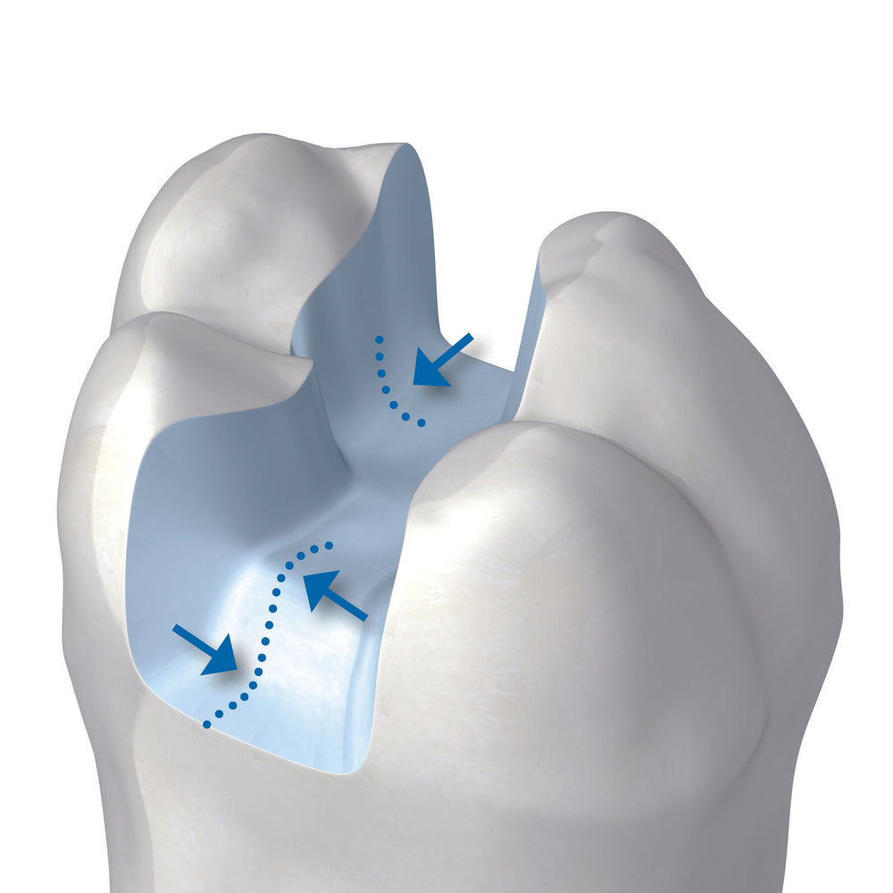 Defect-Oriented: All-Ceramic Inlays & Partial Crowns – Komet UK