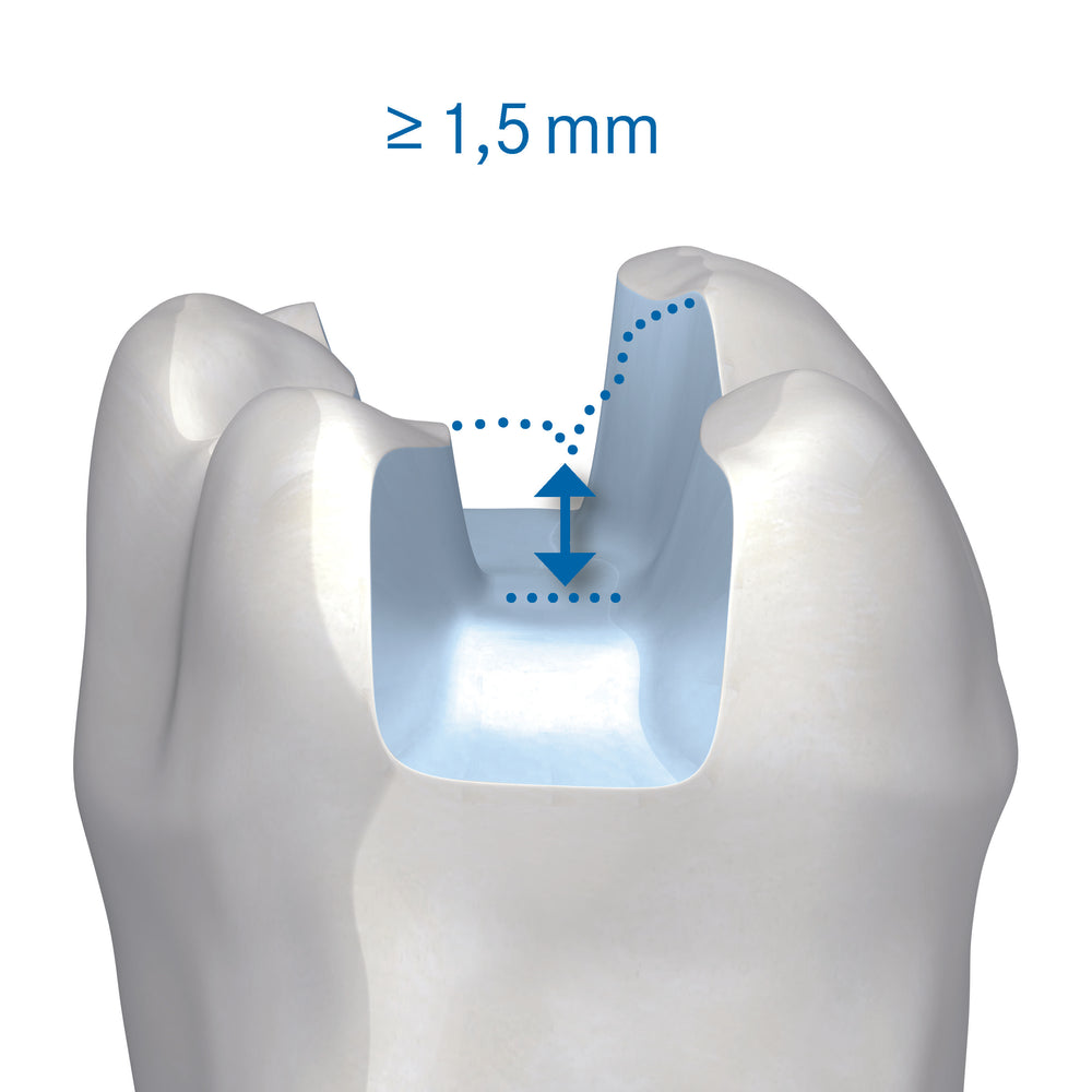 Defect-Oriented: All-Ceramic Inlays & Partial Crowns – Komet UK