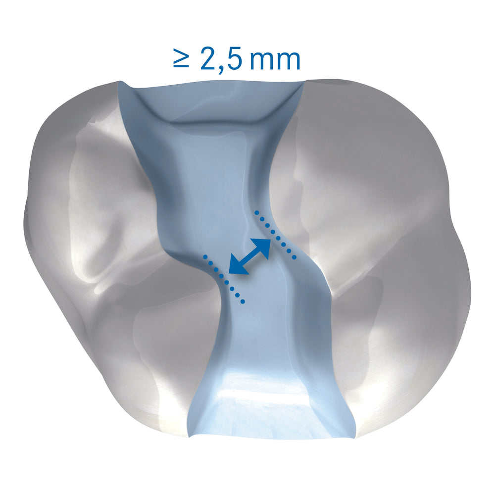 Defect-Oriented: All-Ceramic Inlays & Partial Crowns – Komet UK