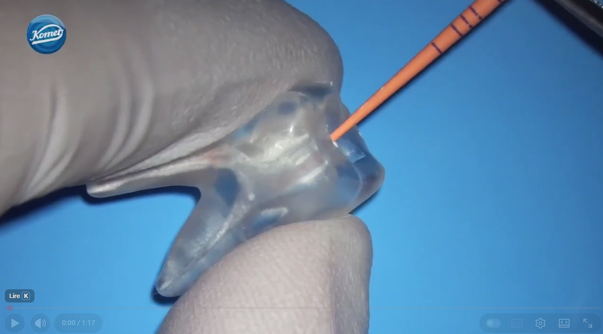 Obturation – Komet UK